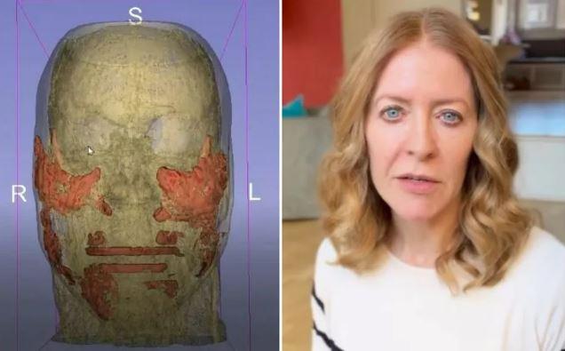 Jornalista revela que ácido hialurônico, usado na harmonização facial ...