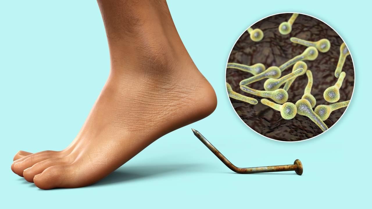 Tétano: Especialista explica como funciona transmissão e sintomas da ...